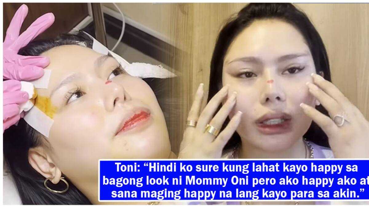 Toni Fowler, pinakita ang resulta ng pagpaparetoke niya sa kanyang mata - KAMI.COM.PH