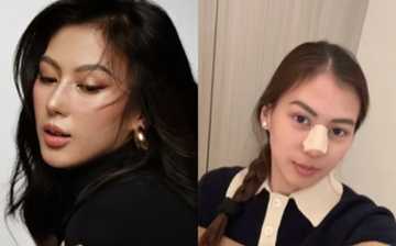 Alex Gonzaga, ipinatanggal ang nose implant: “Back to normal nose na ...