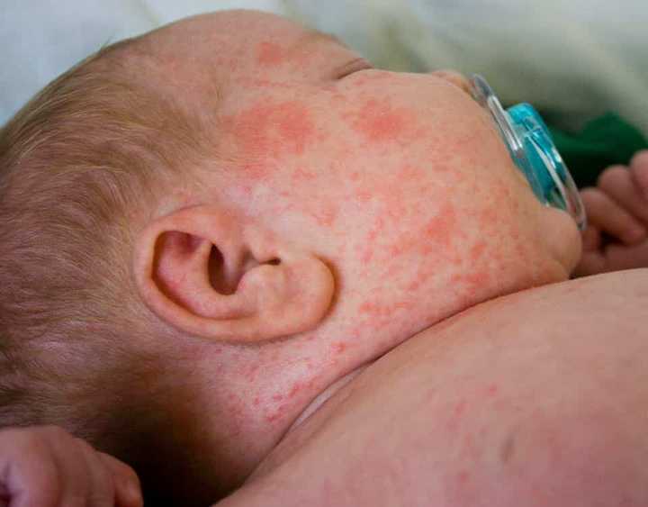 Bungang araw remedy: how to get rid of heat rash (prickly heat) - KAMI ...